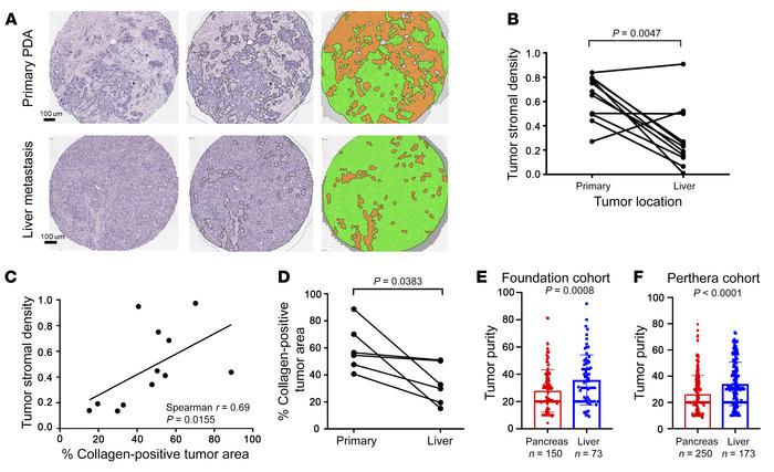 JCI - Pancreatic ductal adenocarcinoma progression is restrained by ...