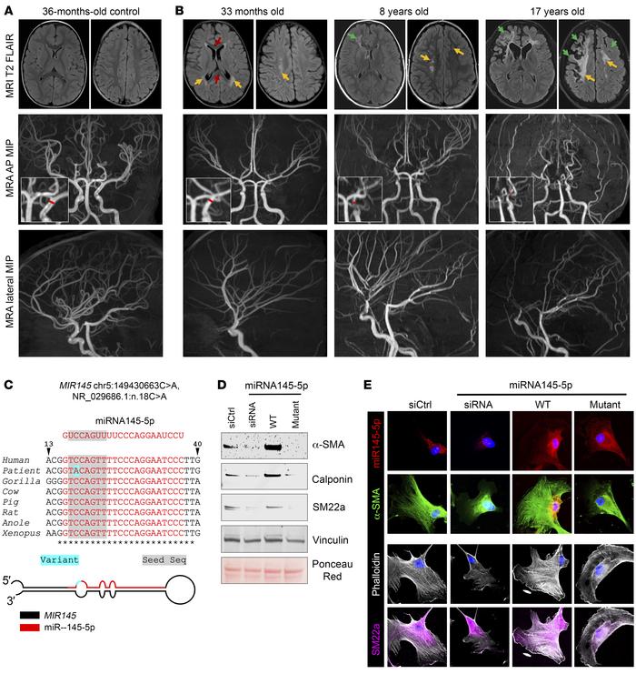 JCI - A seed sequence variant in miR-145-5p causes multisystem smooth ...