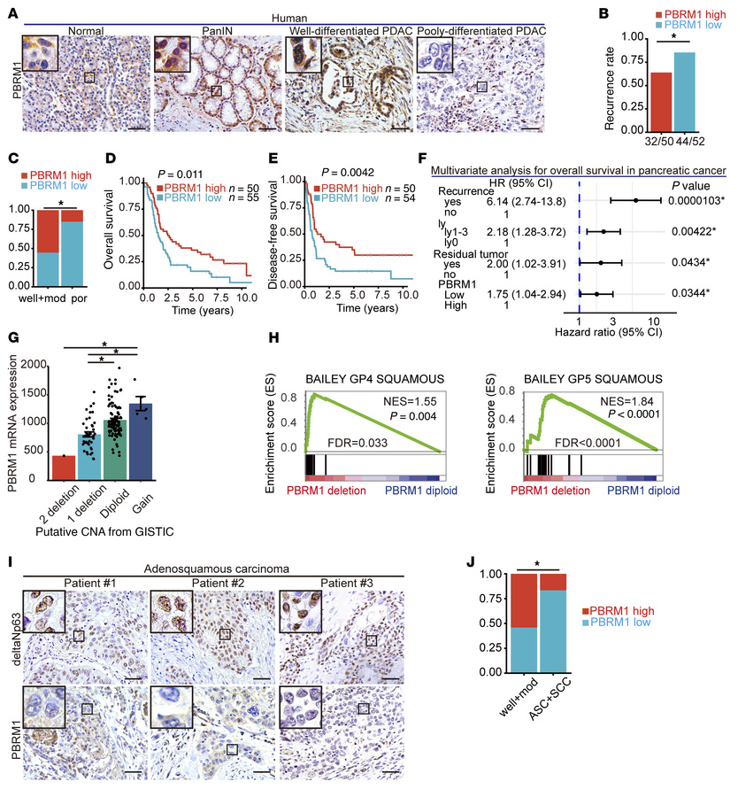 JCI - Polybromo 1/vimentin axis dictates tumor grade, epithelial ...
