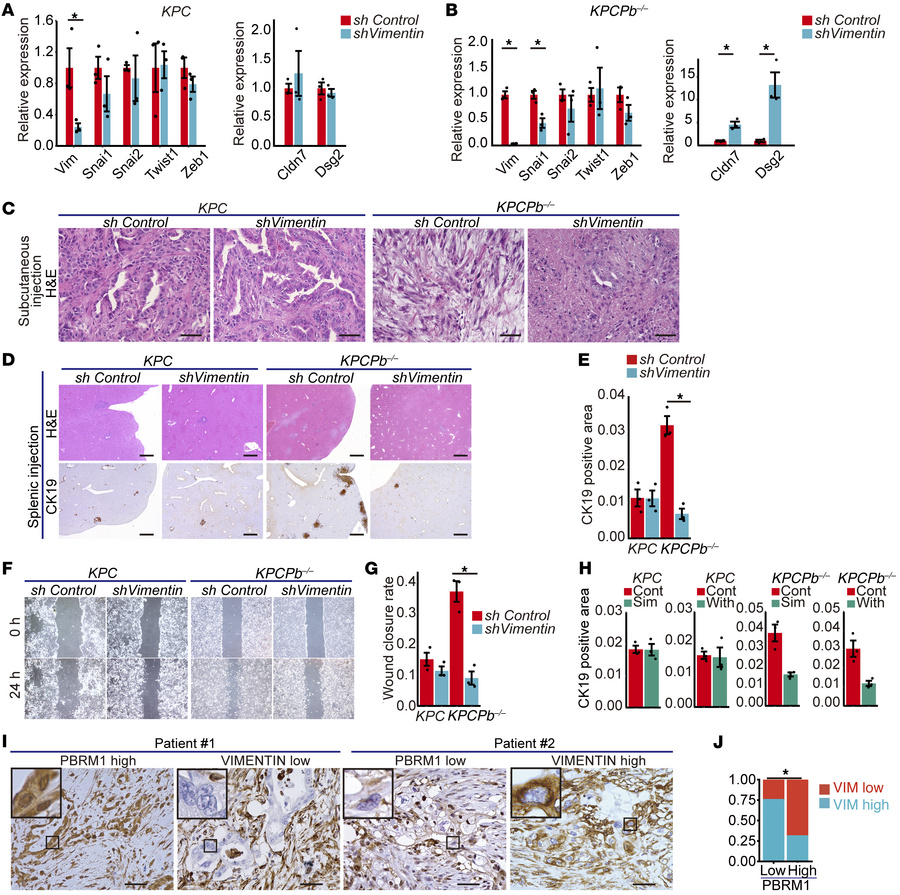 JCI - Polybromo 1/vimentin axis dictates tumor grade, epithelial ...