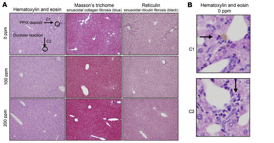 JCI - The GLYT1 inhibitor bitopertin mitigates erythroid PPIX ...