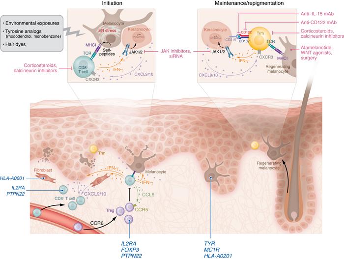 JCI - Recent clinical and mechanistic insights into vitiligo offer new ...