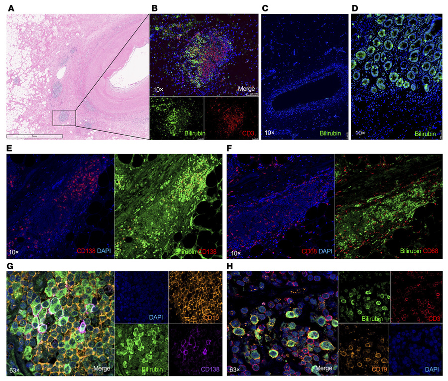 JCI - Dominant intragraft plasma cells targeting bilirubin implicate ...