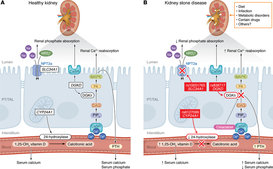 JCI - Genetic susceptibility to kidney stone disease: unveiling ...