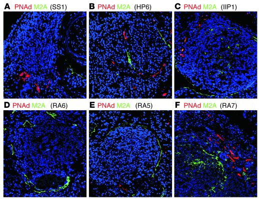 JCI - Inducible bronchus-associated lymphoid tissue (iBALT) in patients ...