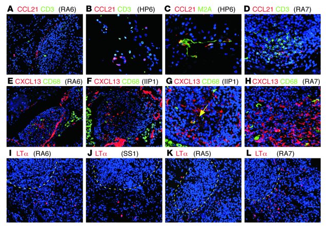 JCI - Inducible bronchus-associated lymphoid tissue (iBALT) in patients ...