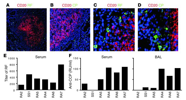 JCI - Inducible bronchus-associated lymphoid tissue (iBALT) in patients ...