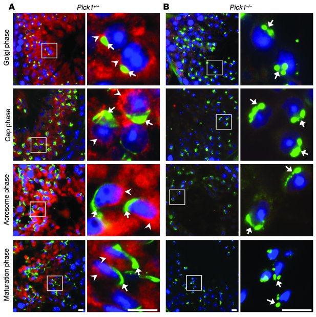 JCI - PICK1 deficiency causes male infertility in mice by disrupting ...