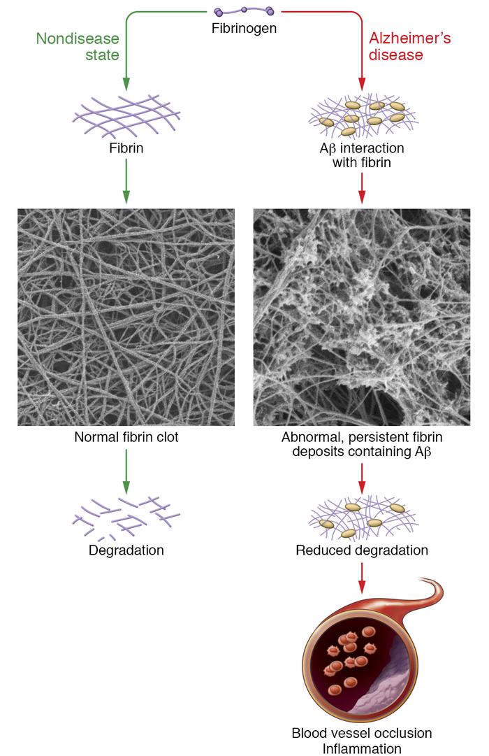 JCI - Blood will out: vascular contributions to Alzheimer’s disease